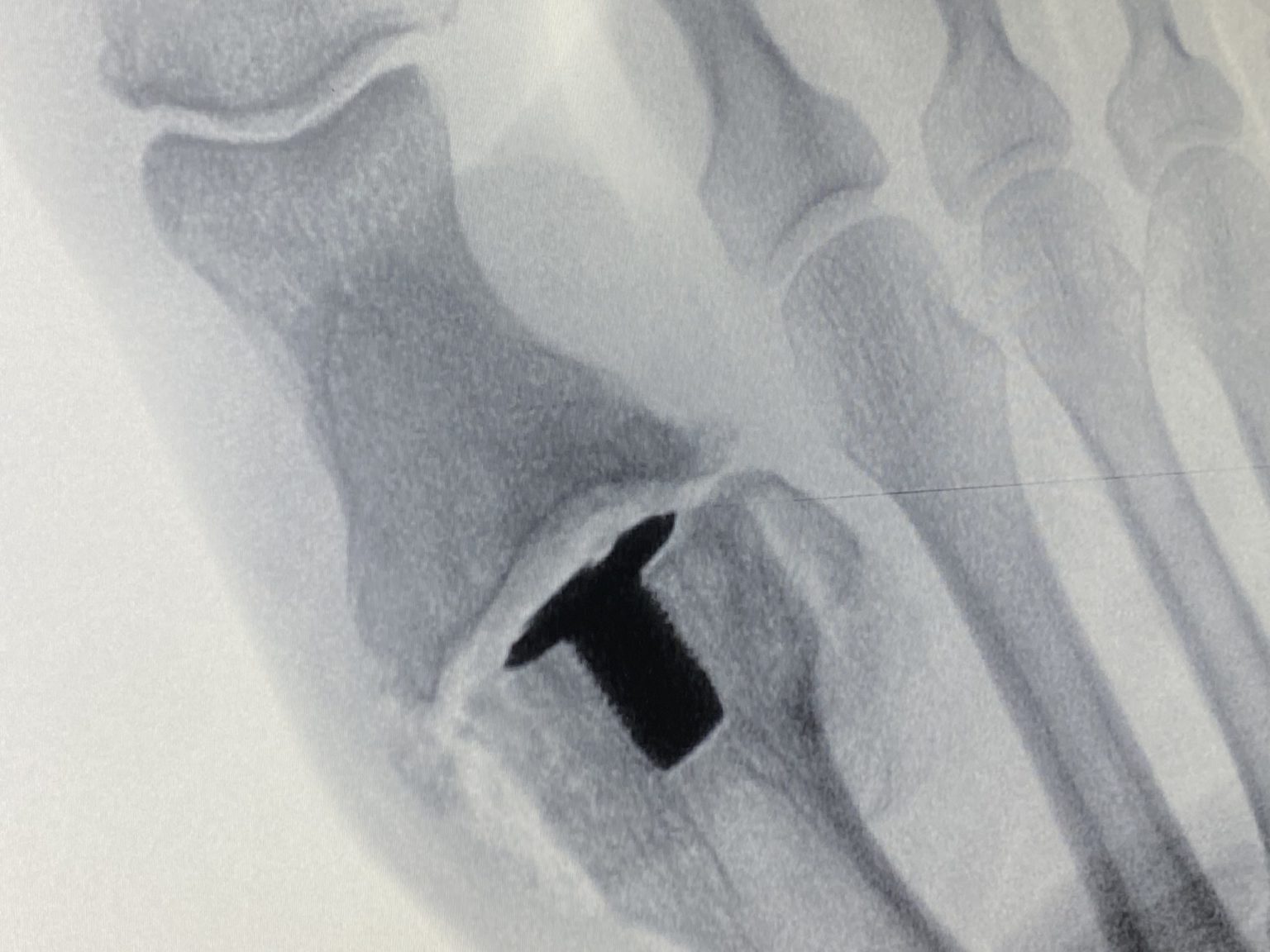 First BioPoly® Great Toe Surgery Performed in the US at CIO Muncie - CIO